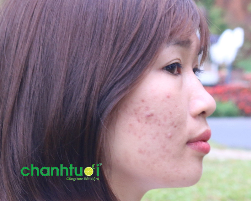 Review D ng Retinol Obagi 1 Cho Da D u Sau 3 Th ng S D ng Review D ng Retinol Obagi 1 Cho Da D u Sau 3 Th ng S D ng